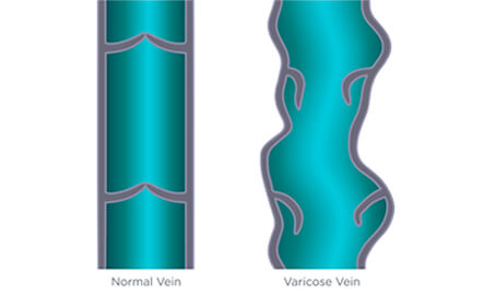 Venous Stasis: Understanding Causes and Treatment - UVG